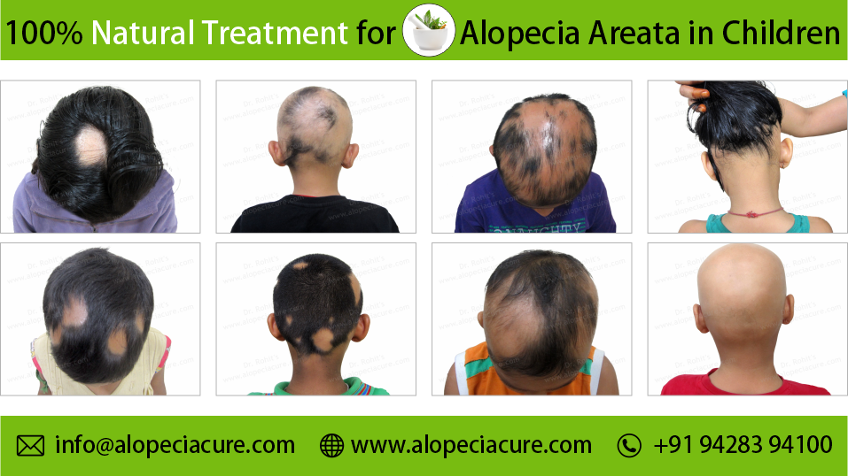 Alopecia areata in children