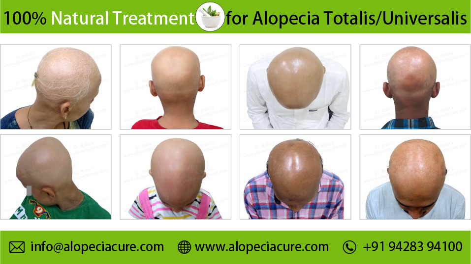 Alopecia Universalis