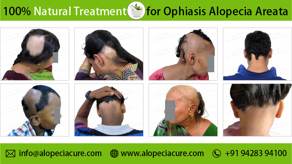 Ophiasis Alopecia Areata