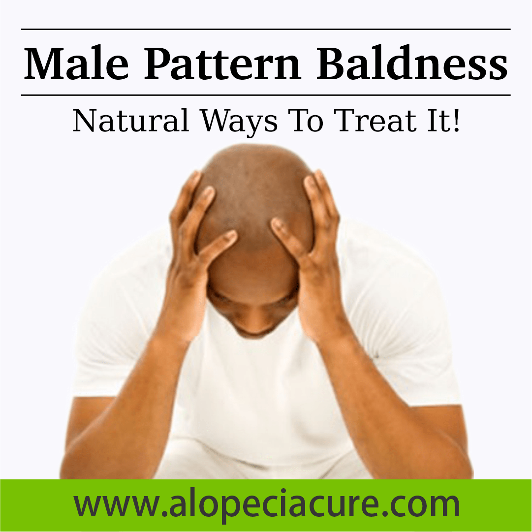 Natural Ways to Treat Male Pattern Baldness | Alopecia Cure